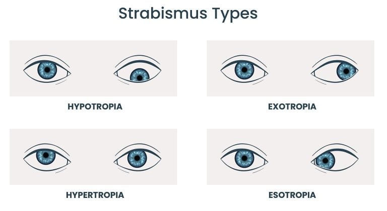 Strabismus (Squint) Treatment Procedures - MyMediTour